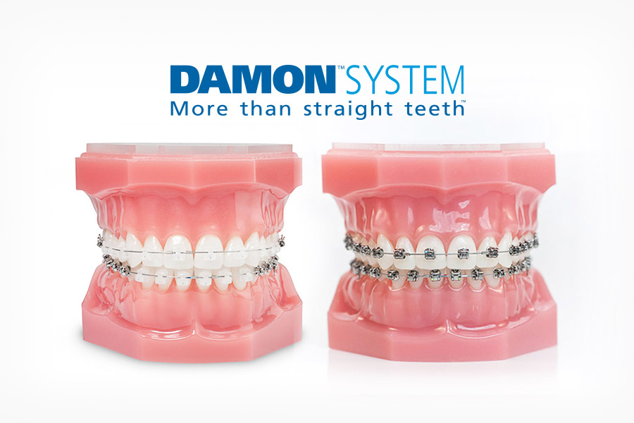 Die revolutionären Zahnspangen jetzt in unserer Praxis - Dr. Eva-Maria ...